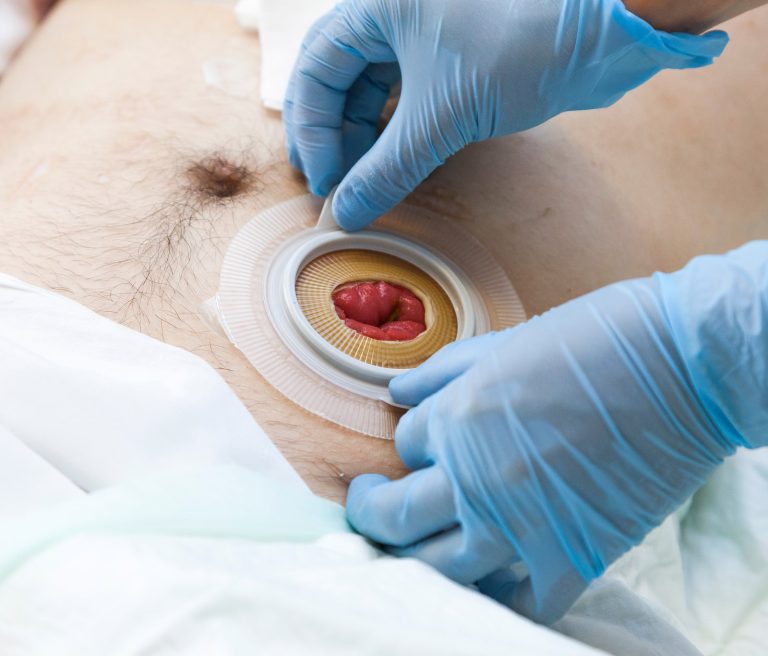 Before Your Stoma Surgery | Preparation Tips & What to Expect